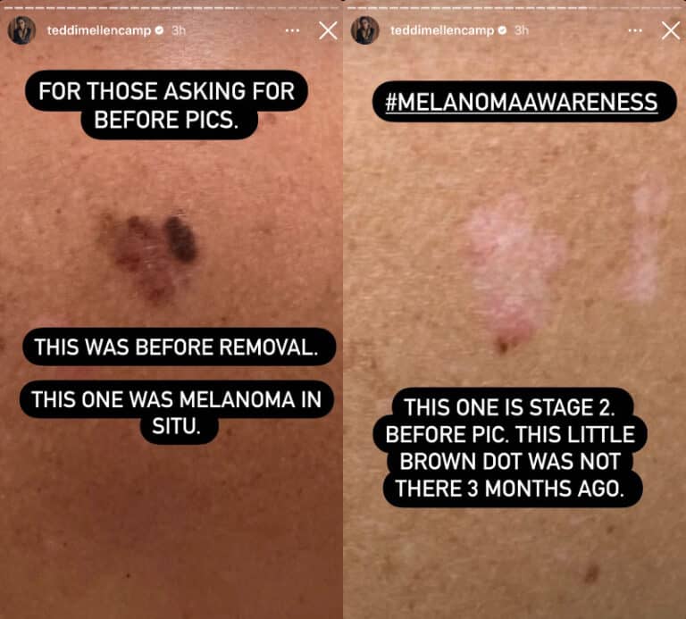 RHOBH: Teddi Mellencamp Confirms Stage 2 Melanoma Diagnosis