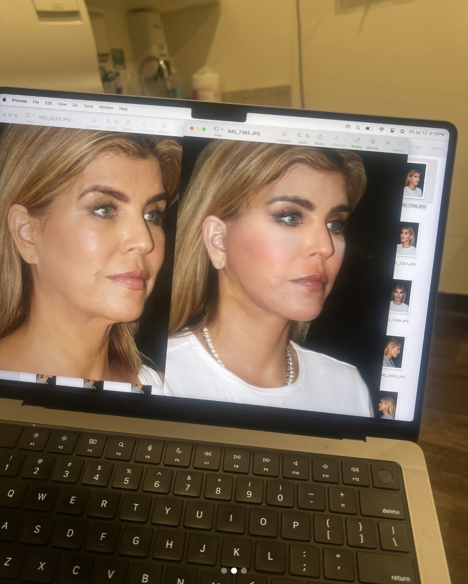 PICS: Ana Quincoces Shares Before and After Facelift Photos