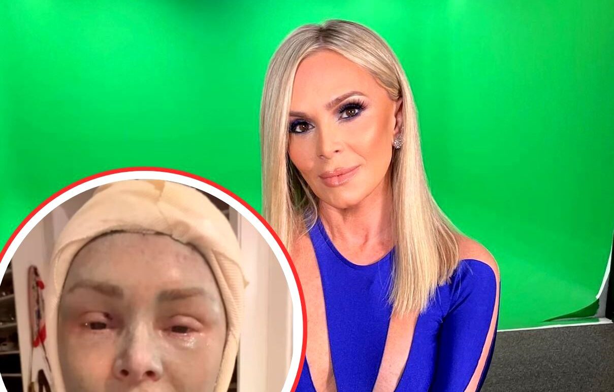 PHOTOS: Tamra Judge Shares Pics of Painful Plastic Surgery