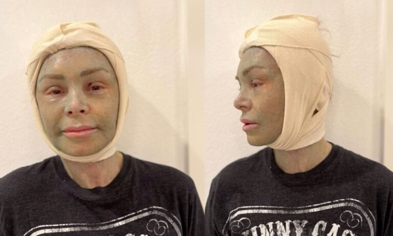 PHOTOS: Tamra Judge Shares Pics of Painful Plastic Surgery