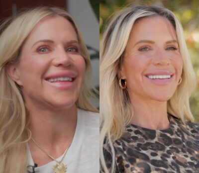 'RHOC' Star Jennifer Pedranti Debuts New Smile, Slams Tamra