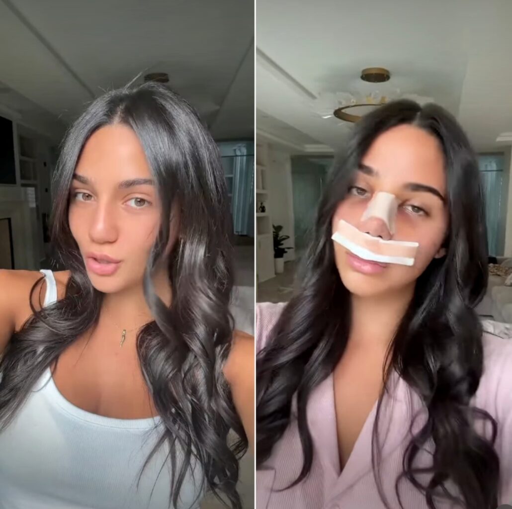 PHOTOS: RHONJ Star Antonia Gorga Gets a Nose Job